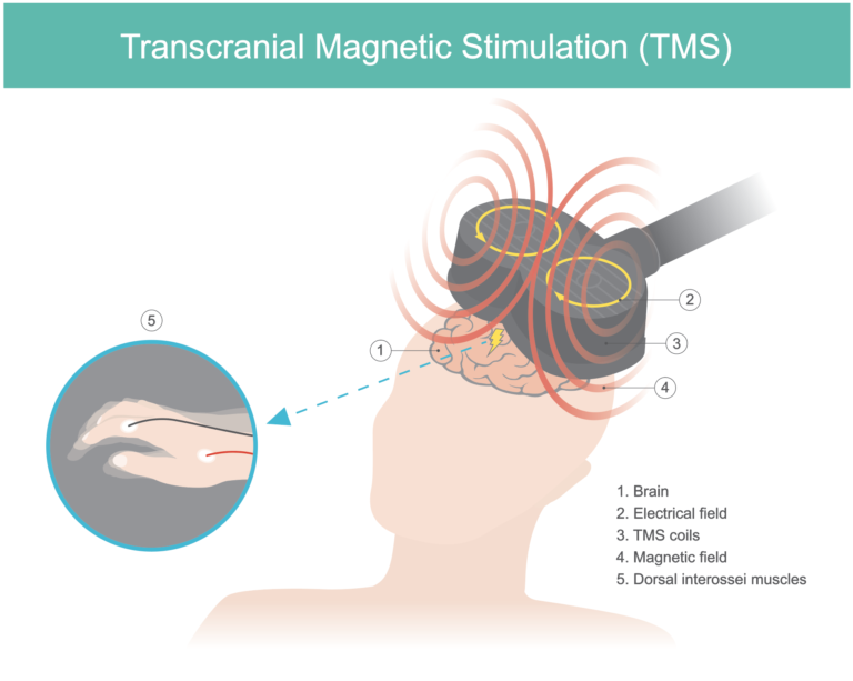 TMS – Transcranial Magnetic Stimulation | Utah Therapy Works